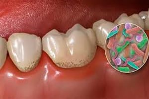 Acumulación de Placa Dental | Clínica Dental | Dr. Ricardo Molina
