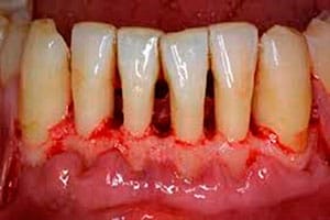 Periodontitis | Estética e Implantología Dental | Dr. Ricardo Molina