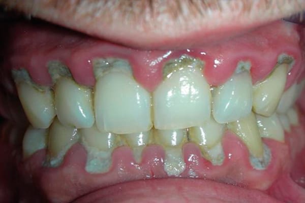 Tartrectomía | Estética e Implantología Dental | Dr. Ricardo Molina